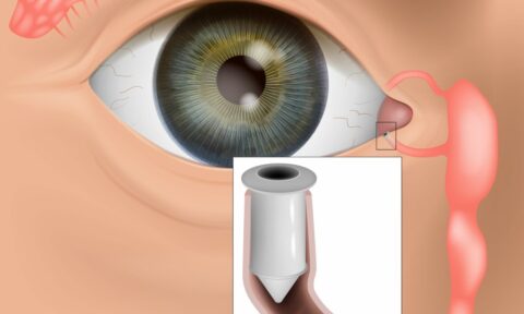 Punctal Plug Materials Explained: Silicone vs. Collagen